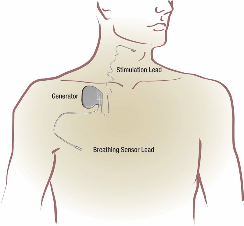 Inspire Therapy For Obstructive Sleep Apnea Charlotte